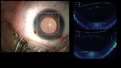 尖峰眼科医院引进蔡司CALLISTO EYE和RESCAN 700术中OCT双导航系统_综合_健康一线资讯